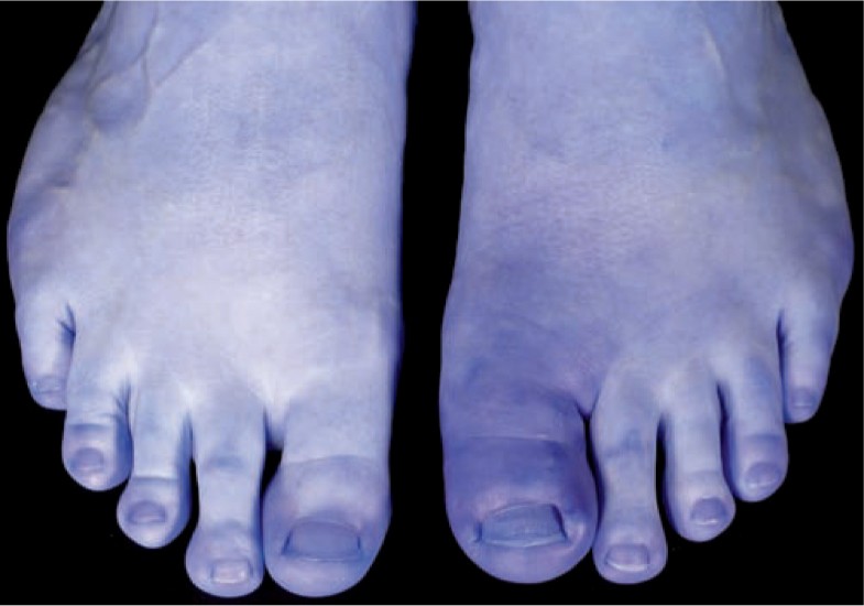 Rheumatoid Vasculitis | SpringerLink