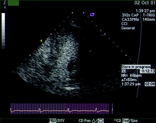The “Ischemic Cascade” | SpringerLink
