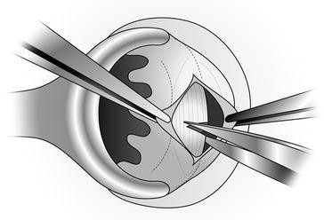 Lateral Internal Sphincterotomy | SpringerLink