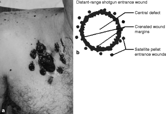 Forensic Aspects of Ballistic Injury | SpringerLink