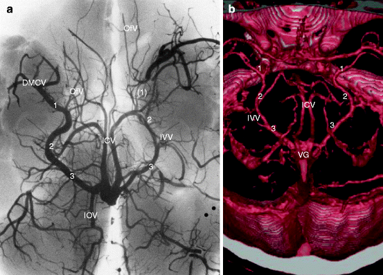 Normal Anatomy of Intracranial Veins: Demonstration with MR Angiography ...