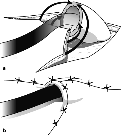 The Malone Procedure and Its Variants | SpringerLink