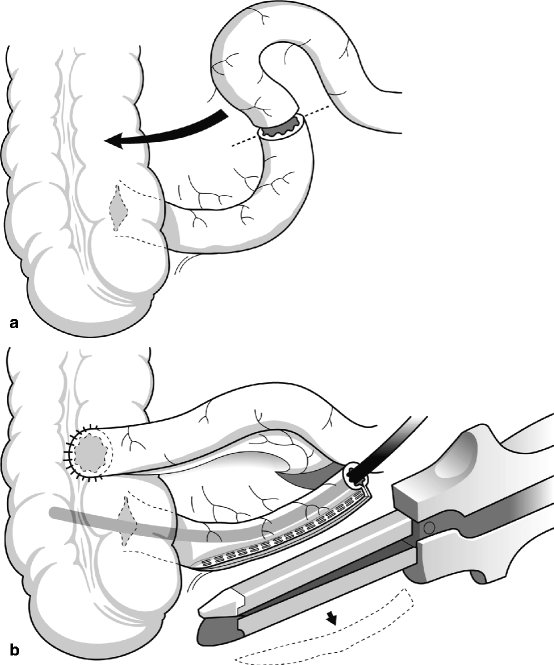 The Malone Procedure and Its Variants | SpringerLink