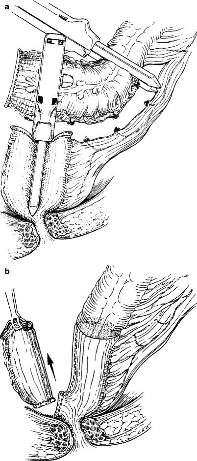 Managing the Megarectum | SpringerLink