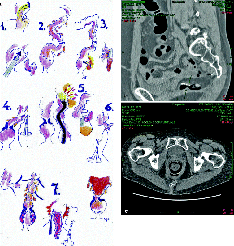 Troubleshooting the Starr Procedure | SpringerLink