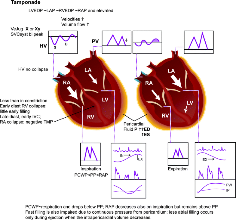 Constrictive Pericarditis and Restrictive Cardiomyopathy | SpringerLink