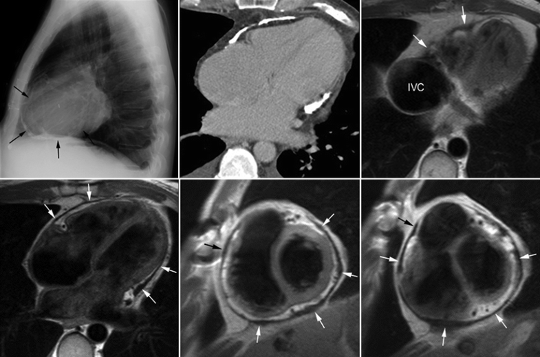 Constrictive Pericarditis and Restrictive Cardiomyopathy | SpringerLink