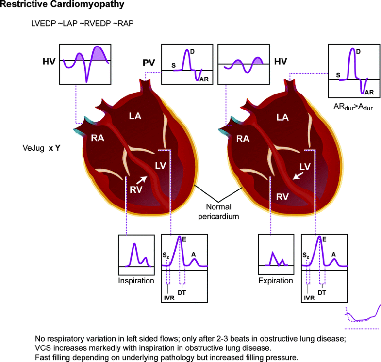 Constrictive Pericarditis and Restrictive Cardiomyopathy | SpringerLink