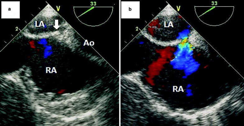 Echocardiography in the Management of Atrial Septal Defect (ASD) and ...