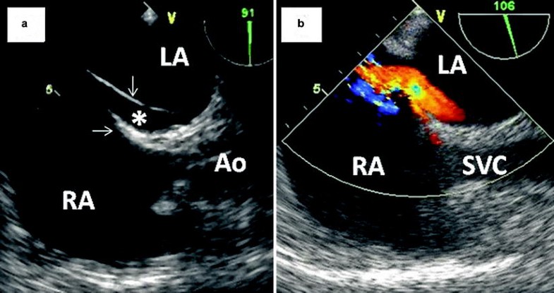 Echocardiography in the Management of Atrial Septal Defect (ASD) and ...