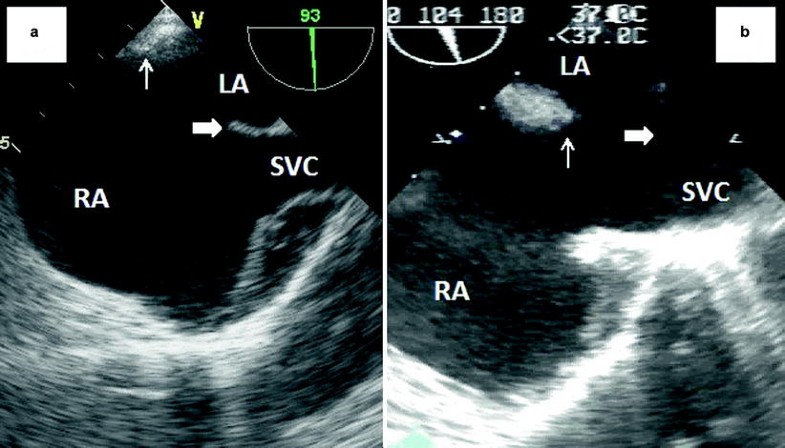 Echocardiography in the Management of Atrial Septal Defect (ASD) and ...
