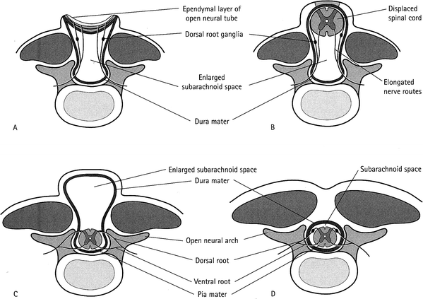Neural Tube Defects, Spina Bifida, and Spinal Dysraphism | SpringerLink