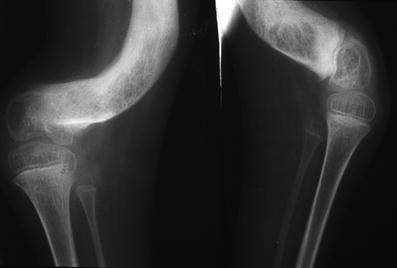 Arthrogryposis multiplex congenita | SpringerLink