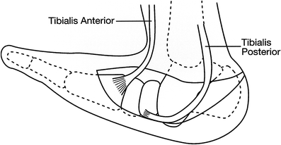 Congenital Vertical Talus (Congenital Convex Pes Valgus) | SpringerLink