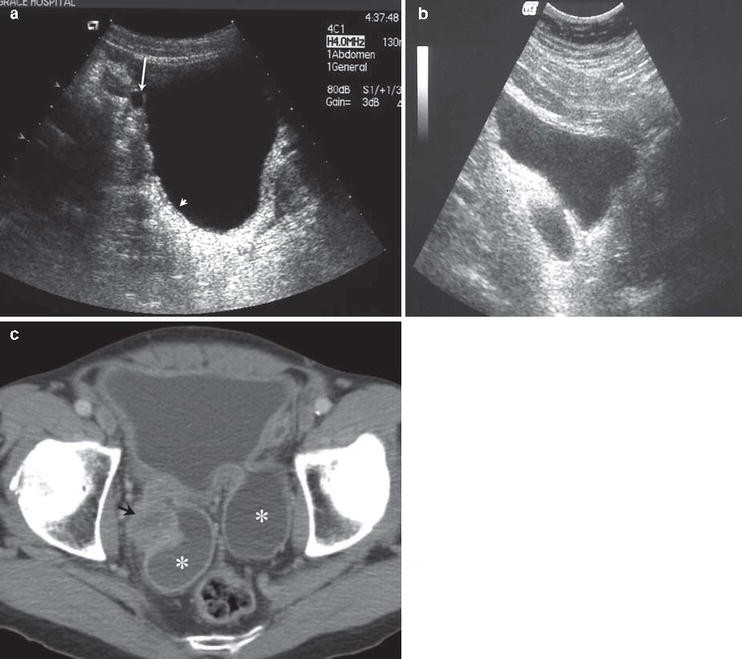 Congenital Anomalies of the Bladder | SpringerLink