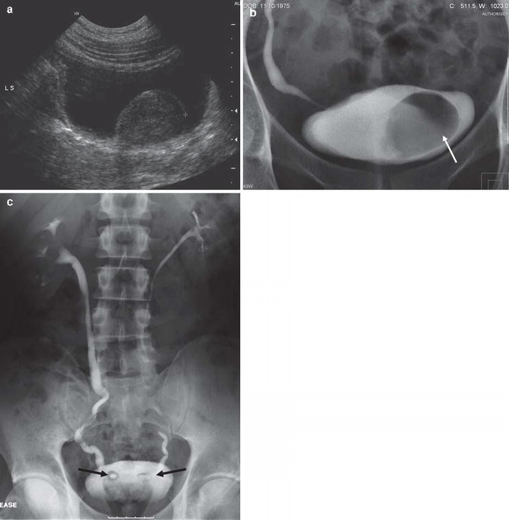 Congenital Anomalies of the Bladder | SpringerLink