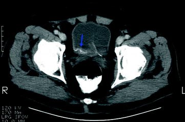 Abnormalities of the Bladder Wall or Mural Abnormalities | SpringerLink