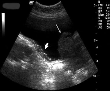Abnormalities of the Bladder Wall or Mural Abnormalities | SpringerLink