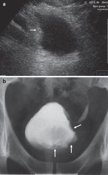 Abnormalities of the Bladder Wall or Mural Abnormalities | SpringerLink