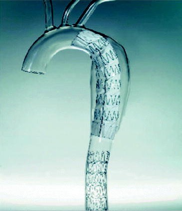 Cook Zenith Dissection Endovascular Stent | SpringerLink