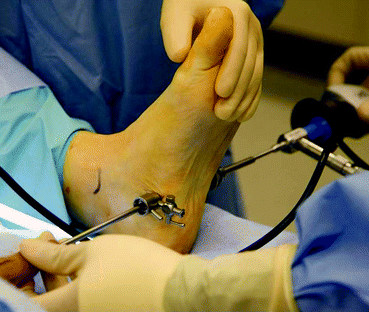 Endoscopic Plantar Fasciotomy | SpringerLink