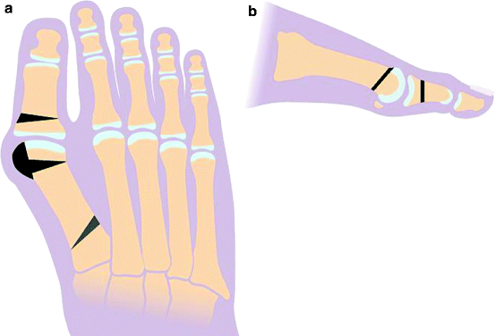The Reverdin-Isham Procedure for the Correction of Hallux valgus ...