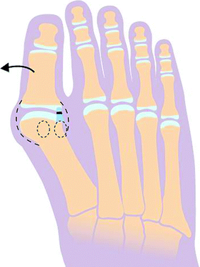 The Reverdin-Isham Procedure for the Correction of Hallux valgus ...