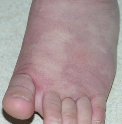 Erythematous Macules. Erythema | SpringerLink