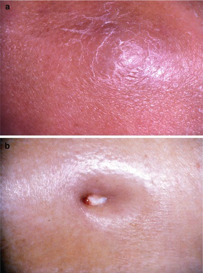 Palpable and Solid Lesions | SpringerLink