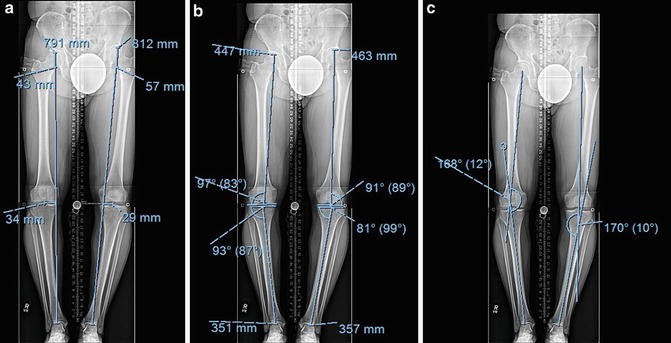 Bilateral Genu Varum and LLD Corrected with an Internal Lengthening IMN ...