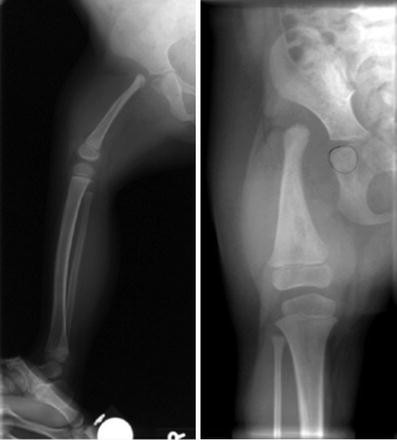 Congenital Femoral Deficiency: Paley Type 2a | SpringerLink