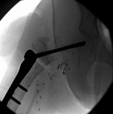 Van Nes Rotationplasty and Hip Reconstruction in the Treatment of ...