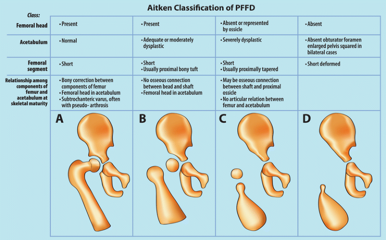 Congenital Lower Limb Deficiencies: An Introduction | SpringerLink
