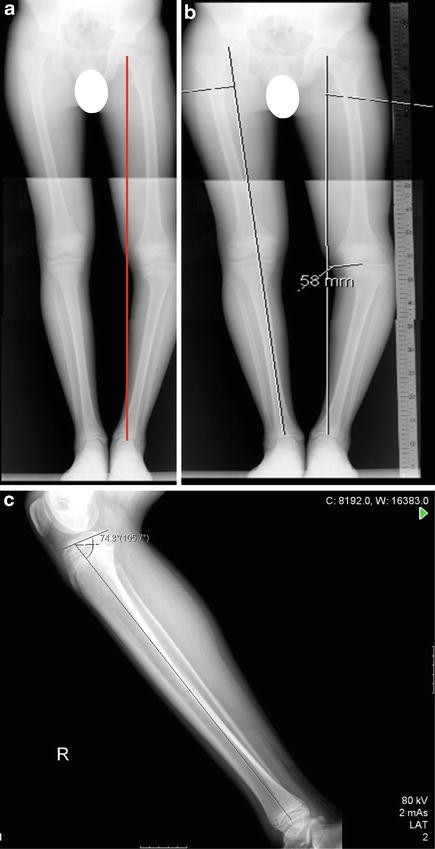 Correction of Adolescent Tibia Vara Without Fibular Osteotomy and ...