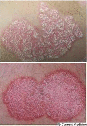 Psoriasis Vulgaris | SpringerLink