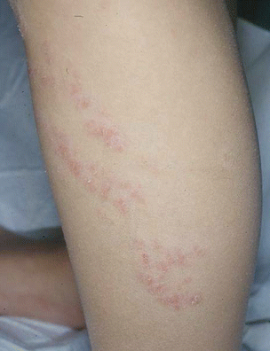 Lichen Striatus | SpringerLink