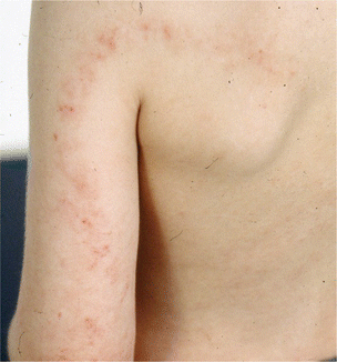 Lichen Striatus | SpringerLink