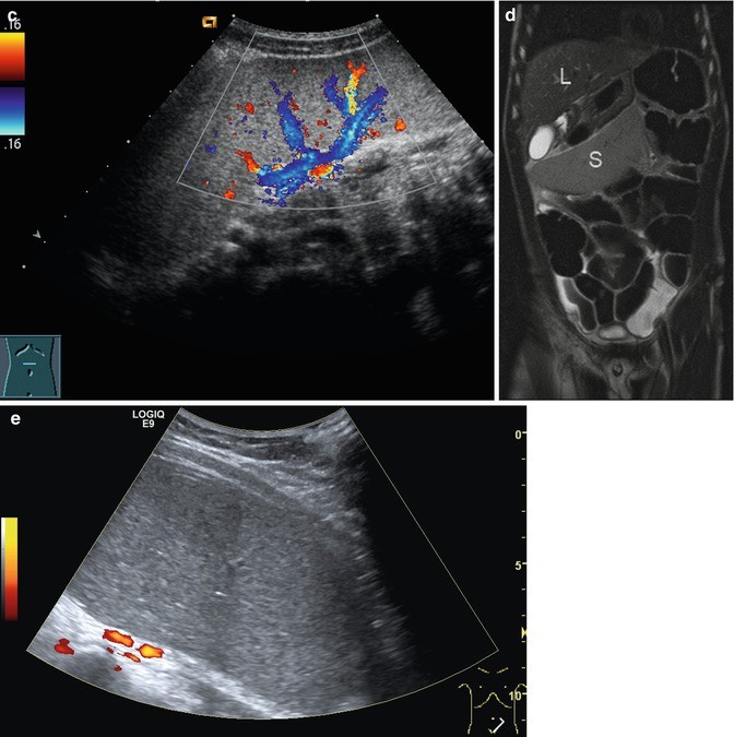Doppler Sonography of the Spleen | SpringerLink