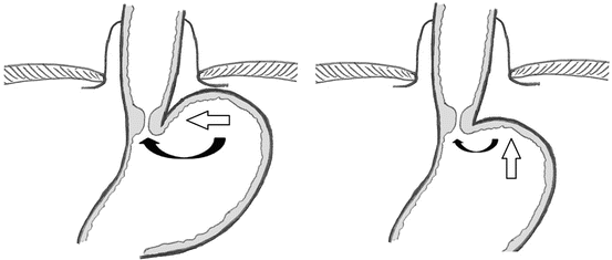 Gastroesophageal Reflux Disease: Pathophysiology | SpringerLink