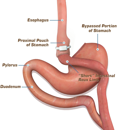 Laparoscopic Banded Gastric Bypass Surgery | SpringerLink