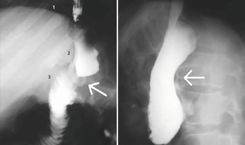 Laparoscopic Banded Gastric Bypass Surgery | SpringerLink