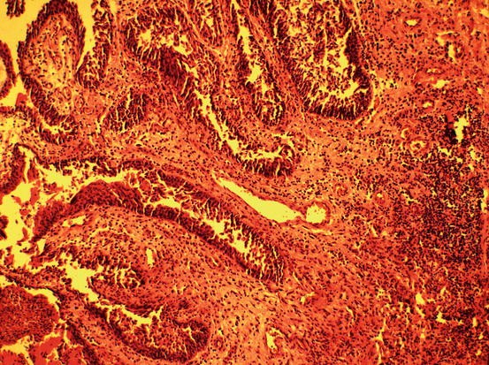 Bladder Tuberculosis | SpringerLink