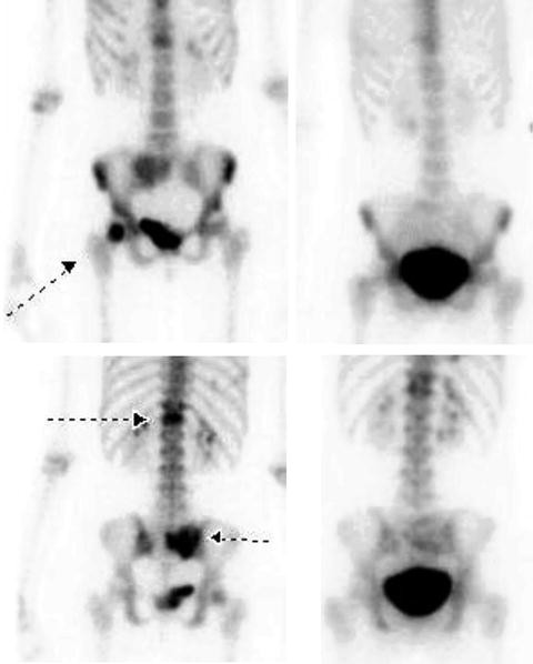 Bone-Seeking Radiopharmaceuticals as Targeted Agents of Osteosarcoma ...