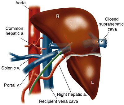 Orthotopic Liver Transplantation: Surgical Techniques | SpringerLink