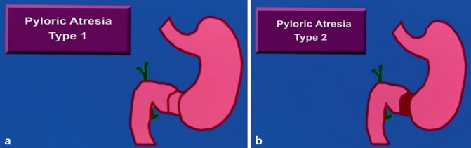 Congenital Gastric Outlet Obstruction (Pyloric and Antral Atresia and ...