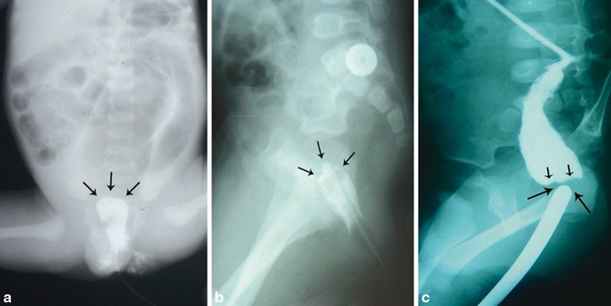 Congenital Rectal Stenosis and Atresia | SpringerLink