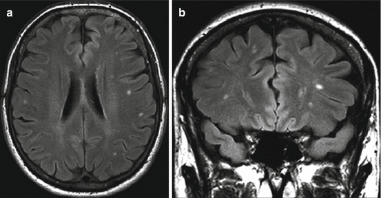 Imaging of Migraine and Vestibular Migraine | SpringerLink