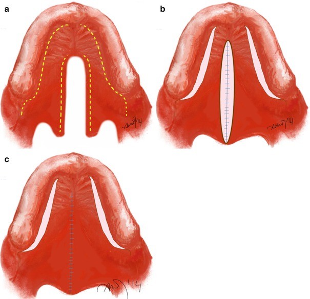 Cleft Lip and Palate Treatment | SpringerLink