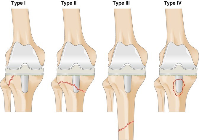 13 Periprosthetic Fractures Following Total Knee Replacement | SpringerLink
