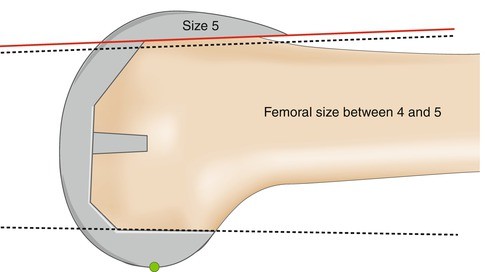 15 The Problem of Under-or Oversizing of Total Knee Replacement ...